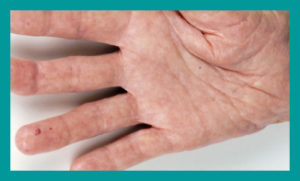 CREST Syndrome Treatment London - Guardian Featured Clinic